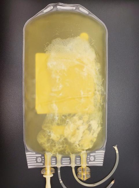 Platelets Bacterial Contamination Professional Education